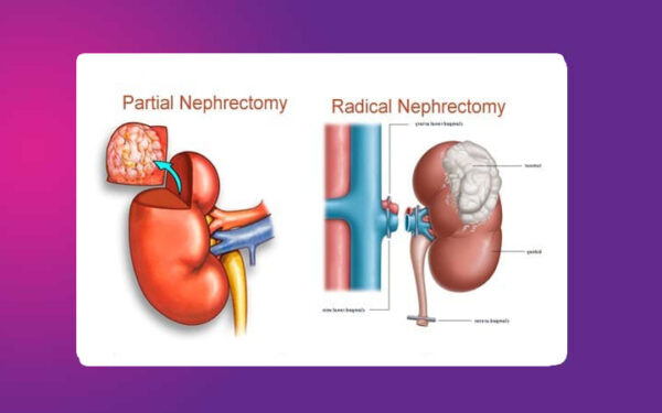 Radical Nephrectomy, Kidney Consultant in Dubai, Kidney Stone Removal Procedure