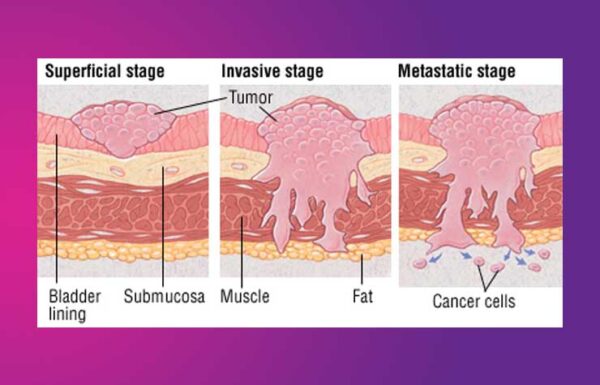 Bladder Cancer, Bladder surgery, Bladder Consultant in Dubai