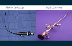 Cystoscopy Treatment and Surgery, Treatment for Cyst