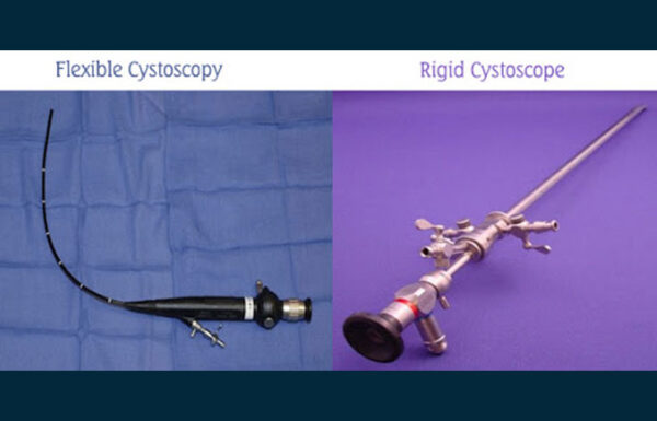 Cystoscopy Treatment and Surgery, Treatment for Cyst