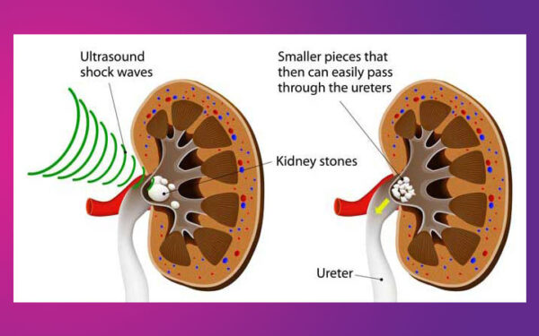 PCNL Procedure for Kidney Stone, Ureteroscopy, Laparoscopic simple ...